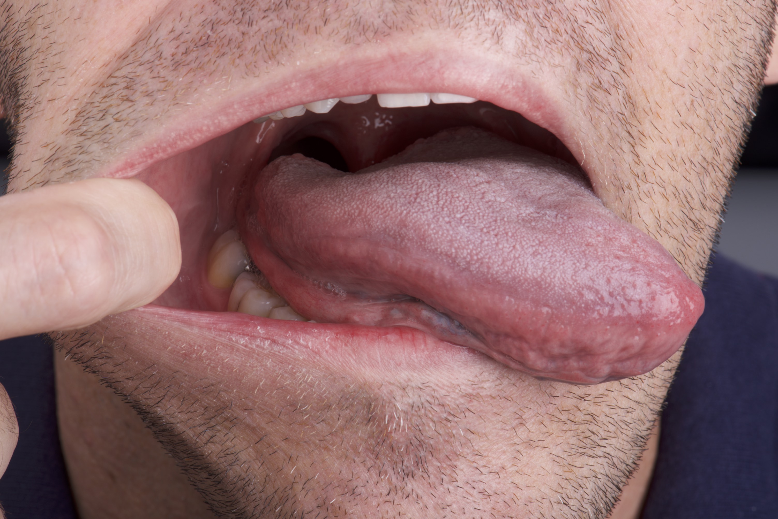 Normal Side Of Tongue Normal Side Of Tongue